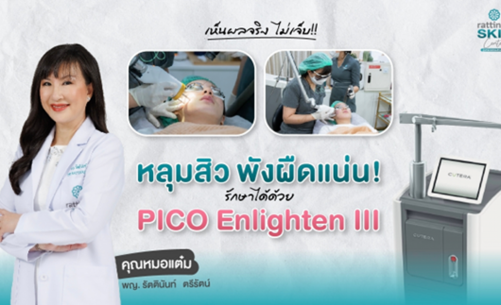 หลุมสิว พังผืดแน่น รักษาได้ด้วย “Pico Enlighten III”